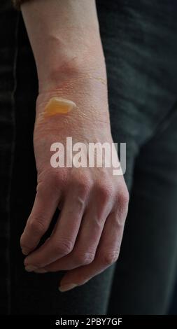 Human skin burn from boiled tea water leaving red mark Stock Photo - Alamy