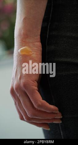 Human skin burn from boiled tea water leaving red mark Stock Photo - Alamy
