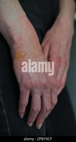 Human skin burn from boiled tea water leaving red mark Stock Photo - Alamy