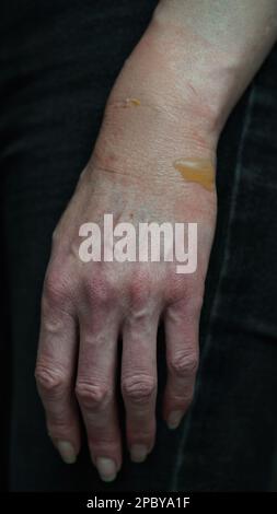 Human skin burn from boiled tea water leaving red mark Stock Photo - Alamy