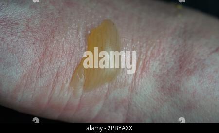 Human skin burn from boiled tea water leaving red mark Stock Photo - Alamy