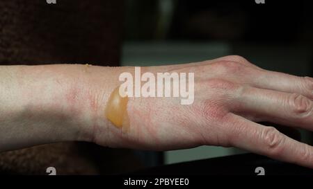 Human skin burn from boiled tea water leaving red mark Stock Photo - Alamy