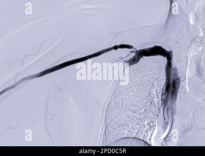 Image of Angioplasty, balloon angioplasty and percutaneous transluminal ...