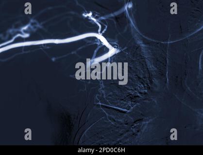 Image of Angioplasty, balloon angioplasty and percutaneous transluminal ...