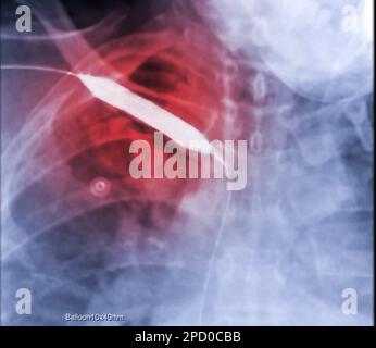 Image of Angioplasty, balloon angioplasty and percutaneous transluminal ...