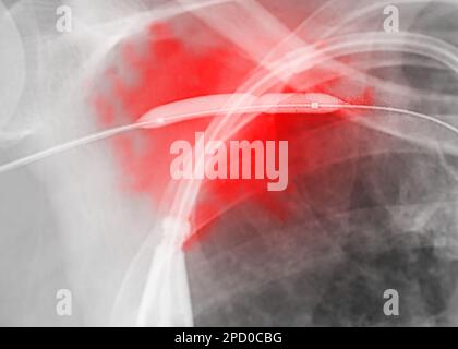 Image of Angioplasty, balloon angioplasty and percutaneous transluminal ...
