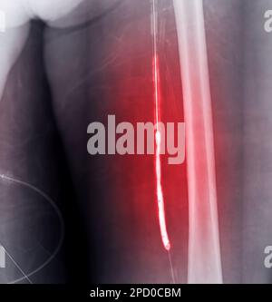 Image of Angioplasty, balloon angioplasty and percutaneous transluminal ...