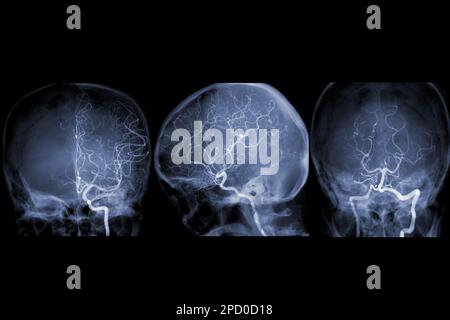 Cerebral angiography image from Fluoroscopy in intervention radiology ...