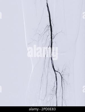 Femoral artery angiogram or angiography Stock Photo - Alamy