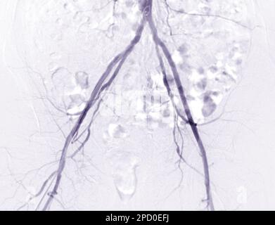Femoral artery angiogram or angiography Stock Photo - Alamy