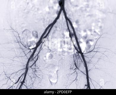 Femoral artery angiogram or angiography Stock Photo - Alamy