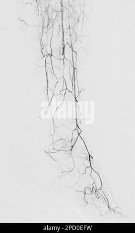 Femoral artery angiogram or angiography Stock Photo - Alamy