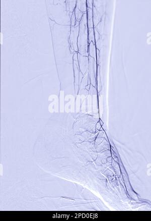 Femoral artery angiogram or angiography Stock Photo - Alamy