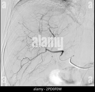Imaging of TACE or Chemoembolization is a procedure that allows a dose ...