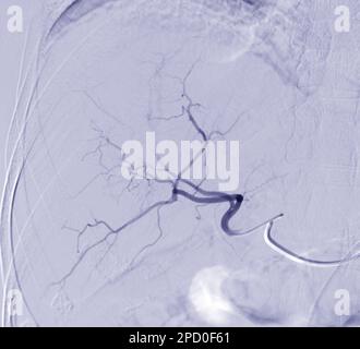Imaging of TACE or Chemoembolization is a procedure that allows a dose ...