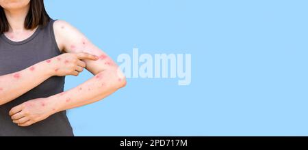 Monkeypox new disease dangerous over the world. Patient with Monkey Pox ...