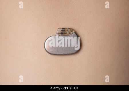 pacemaker on the skin surface Stock Photo - Alamy
