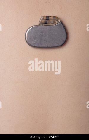 pacemaker on the skin surface Stock Photo - Alamy