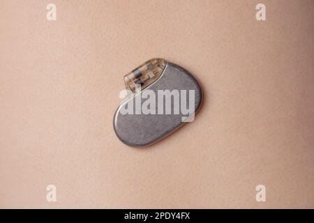pacemaker on the skin surface Stock Photo - Alamy