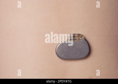 pacemaker on the skin surface Stock Photo - Alamy
