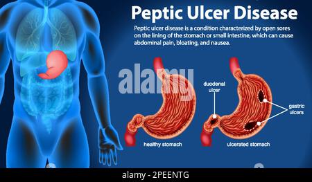 Peptic Ulcer Disease Infographic illustration Stock Vector Image & Art ...