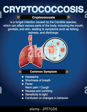Informative poster of Cryptococcosis illustration Stock Vector Image ...
