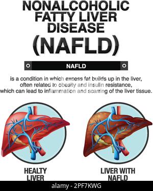 Nonalcoholic Fatty Liver Disease (NAFLD) illustration Stock Vector ...