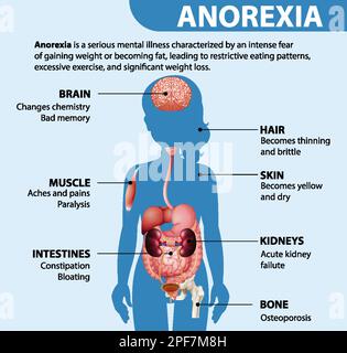 Informative poster of Anorexia eating disorder illustration Stock ...