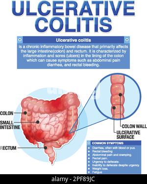 Ulcerative Colitis Symptoms Infographic illustration Stock Vector Image ...