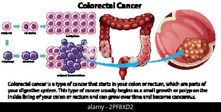 Colorectal Cancer with explanation illustration Stock Vector Image ...