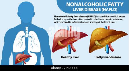 Nonalcoholic Fatty Liver Disease (NAFLD) illustration Stock Vector ...