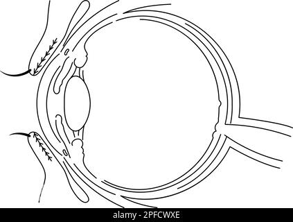 Medical illustration, Anatomical drawing of the site of origin of eye ...