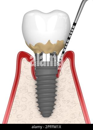 3d render of human gums cross-section with peri implantitis disease ...