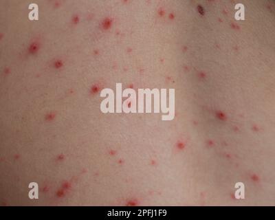 Close up shot of varicella virus or chicken pox bubble rash and blister ...