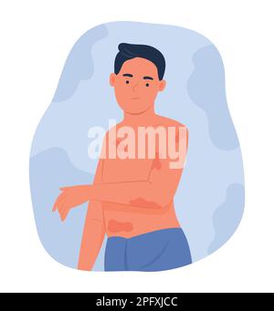 Scabies isolated cartoon vector illustration. Man with red dots on a ...