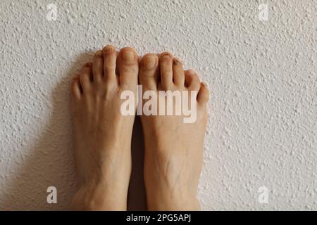 Person feet with subungual hematoma, black toenails caused by trauma ...
