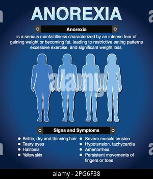 Informative poster of Anorexia eating disorder illustration Stock ...