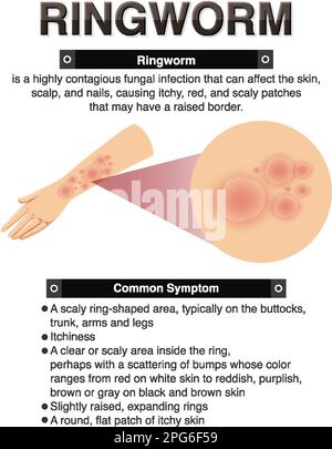 Informative symptoms of Ringworm illustration Stock Vector Image & Art ...
