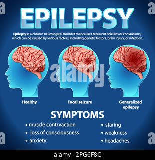 Informative poster of Epilepsy illustration Stock Vector Image & Art ...