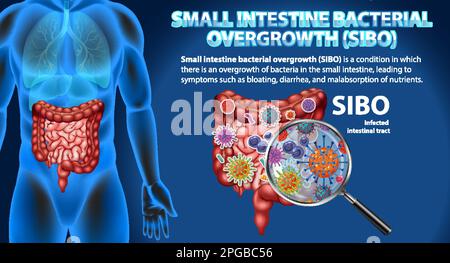 Small Intestine Bacterial Overgrowth (SIBO) illustration Stock Vector ...