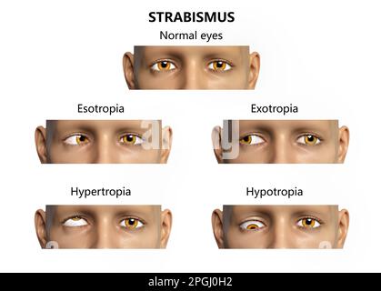 Types of strabismus. Eyes with esotropia, exotropia, hypertropia and ...