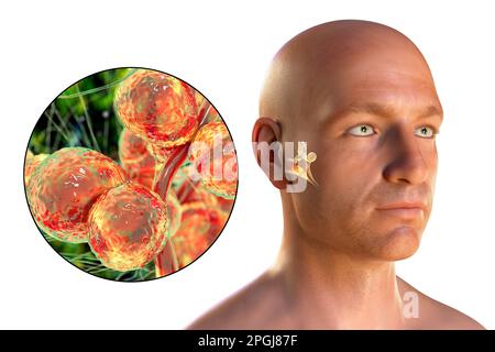 Otitis media infection. Close-up of pus (yellow) in the ear of a five ...
