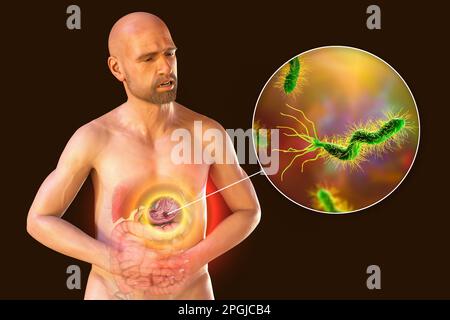 Helicobacter pylori bacteria. Computer illustration of Helicobacter pylori bacteria in a human ...