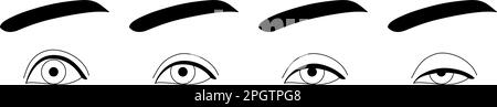 Medical Illustration, Ptosis Symptoms Normal to Severe - Translation ...