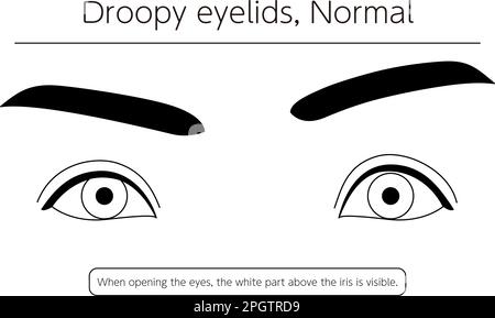 Medical Illustration, Ptosis Symptoms Normal to Severe - Translation ...