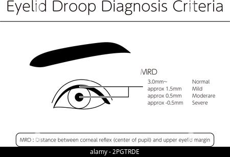 Medical illustration: Diagram of severe ptosis (eyelid drooping ...