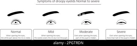 Medical Illustration, Ptosis Symptoms Normal to Severe - Translation ...