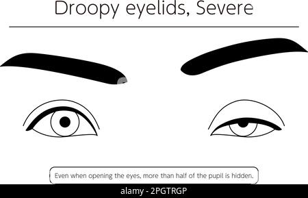 Medical illustration: Diagram of moderate ptosis (eyelid drooping ...