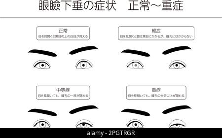 Medical Illustration, Ptosis Symptoms Normal to Severe - Translation ...