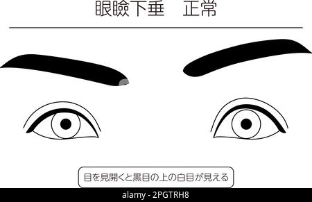 Medical illustration: Diagram of normal state of ptosis (eyelid ...